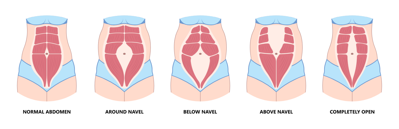 Understanding Diastasis Recti | Orchard Clinic Singapore